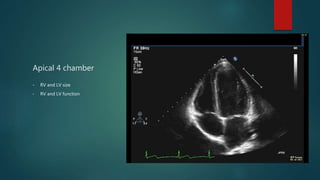Use of bedside ultrasound in shock: RUSH protocol | PPTX | Death ...