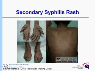 Russell Waddell: Syphilis Presentation and Treatment | PPT