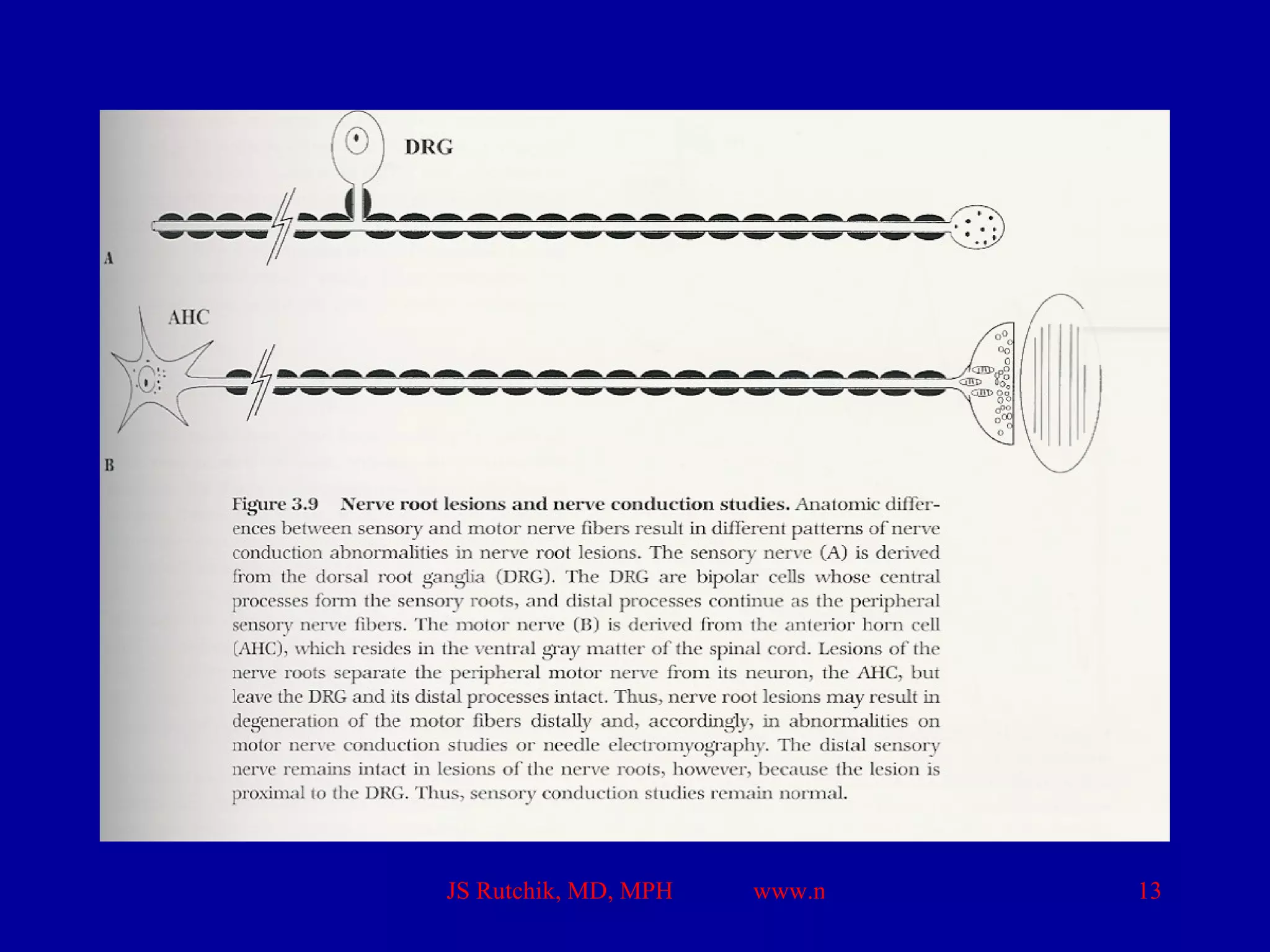 ELECTROMYOGRAPHY AND UPPER EXTREMITY DISORDERS | PPT