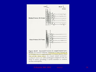 ELECTROMYOGRAPHY AND UPPER EXTREMITY DISORDERS | PPT