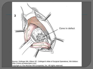 Rutkow and robbins | PPT