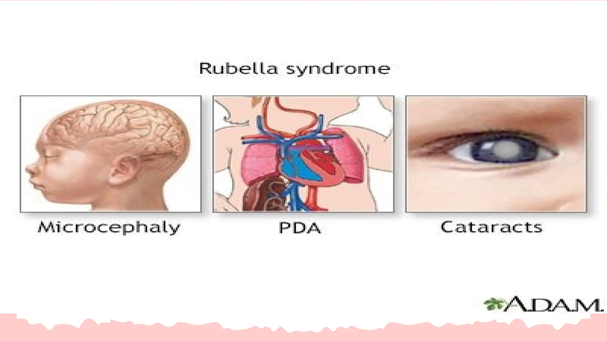 Ppt on rubella it's transmission and problems in pregnancy | PPTX