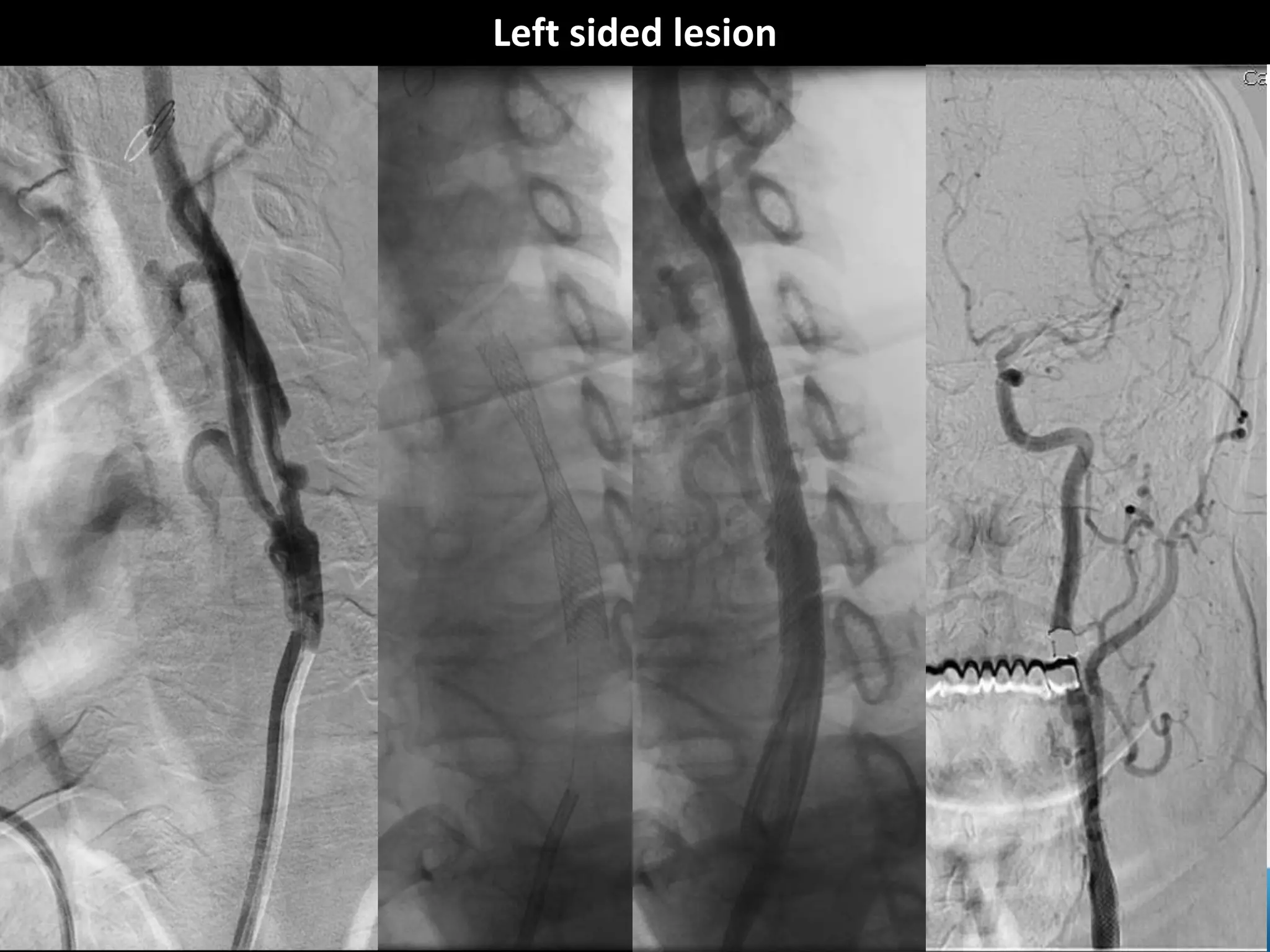 Ruzsa Z - AIMRADIAL 2014 Endovascular - Carotid artery stenting | PPTX