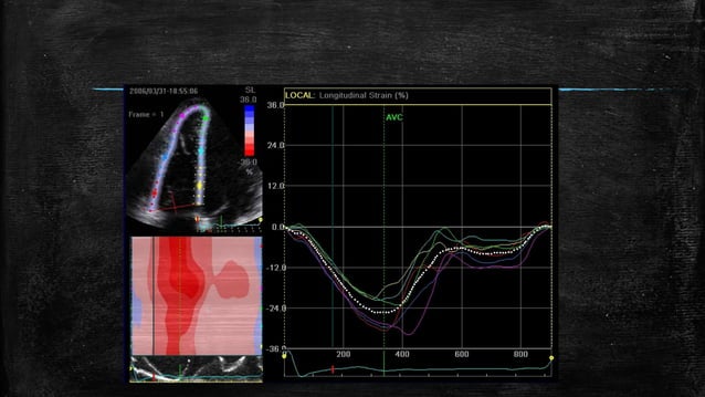 Right Ventricle Echocardiography | PPTX | Heart and Cardiovascular ...