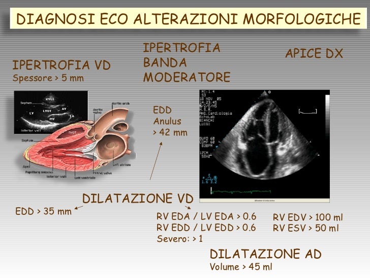VALUTAZIONE ECOCARDIOGRAFICA del VENTRICOLO DESTRO 1 - right ventricl…