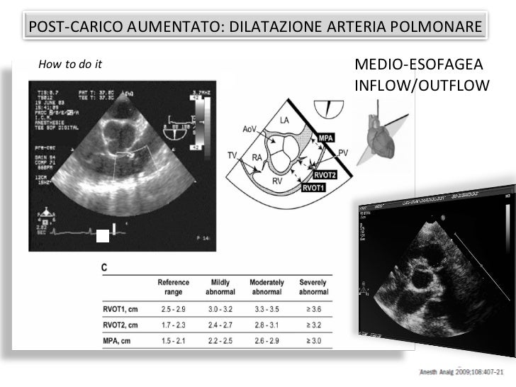 VALUTAZIONE ECOCARDIOGRAFICA del VENTRICOLO DESTRO 2 - right ventricl…