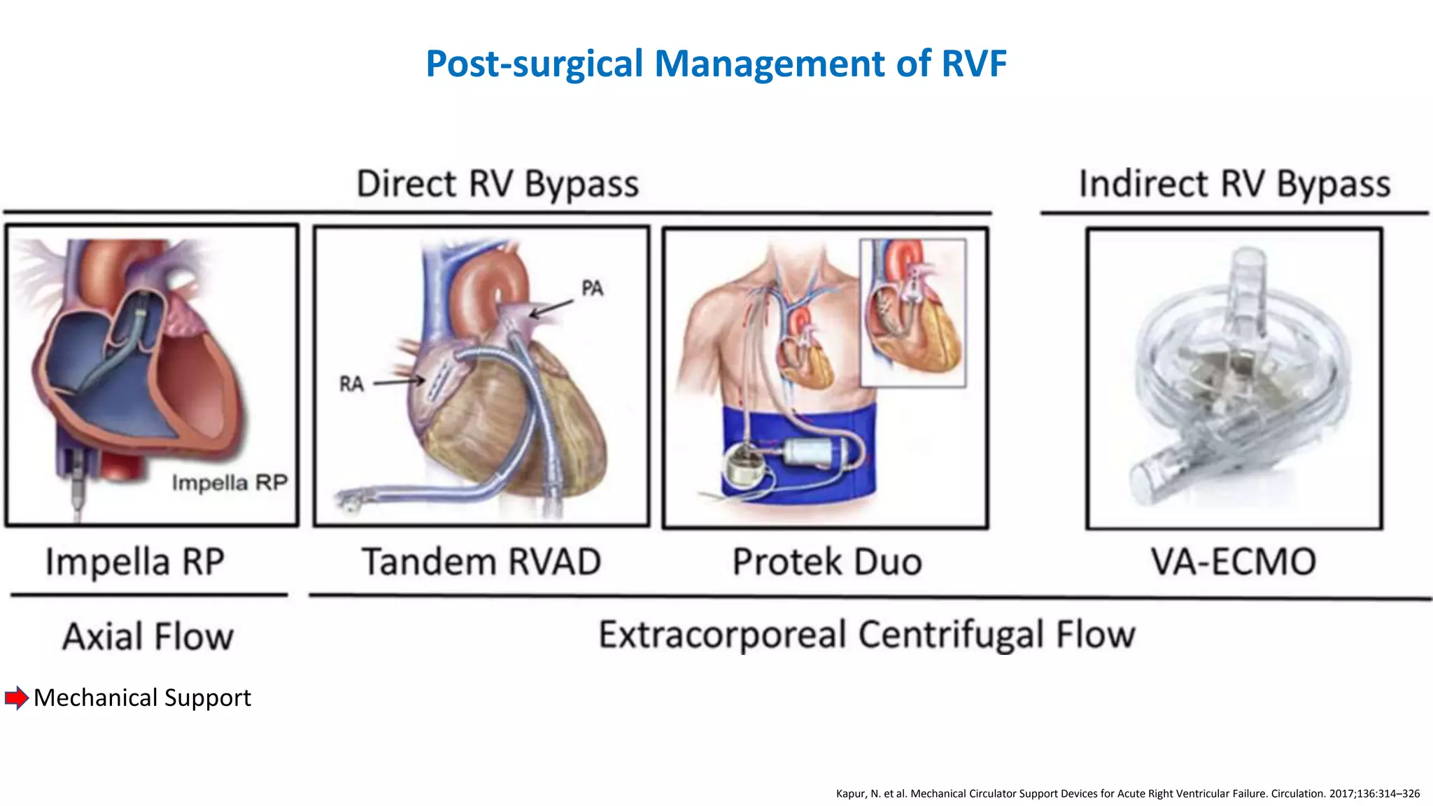 Right Ventricular Failure | PPTX