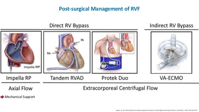 Right Ventricular Failure