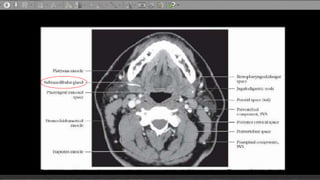 CT anatomy of Neck Spaces RV | PPTX