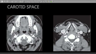 CT anatomy of Neck Spaces RV | PPTX