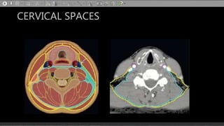 CT anatomy of Neck Spaces RV | PPTX