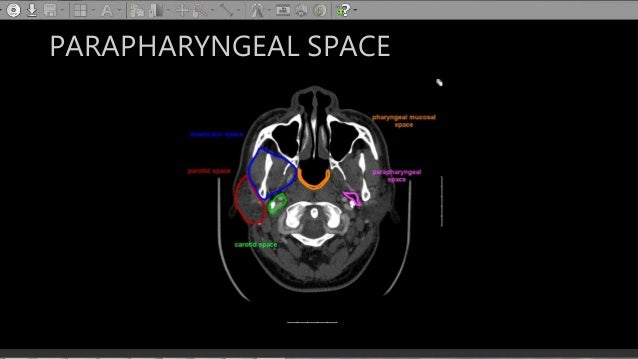CT anatomy of Neck Spaces RV