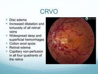Retinal Vein Occlusion Studies | PPT