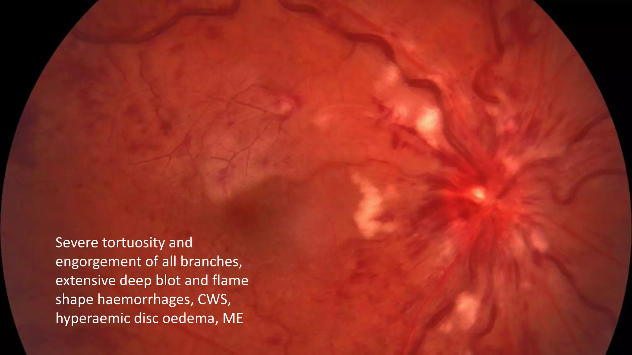 Retinal Vein Occlusion | PPTX