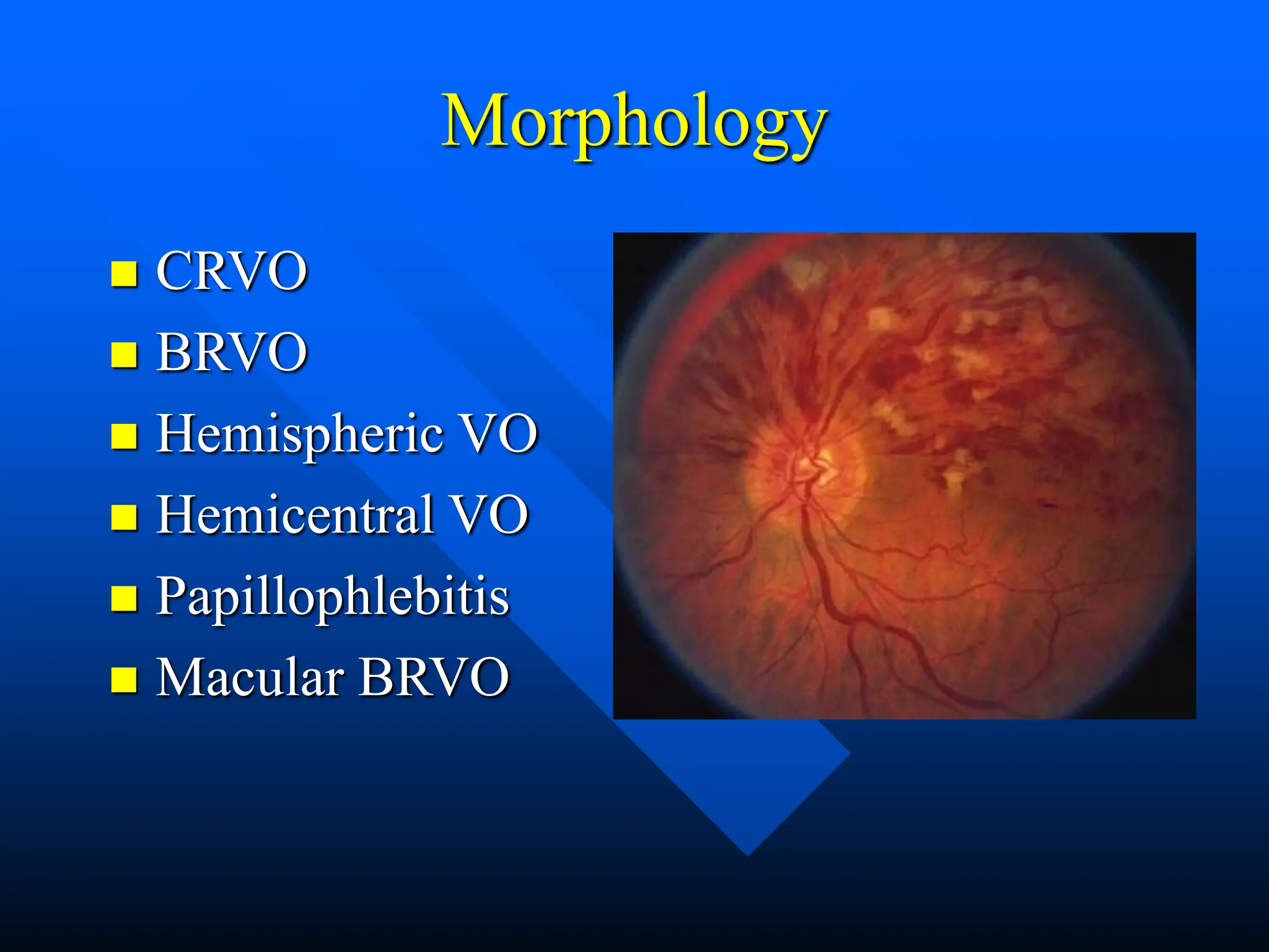 rvo.ppt retinal vein occlusion reti00nal | PPT