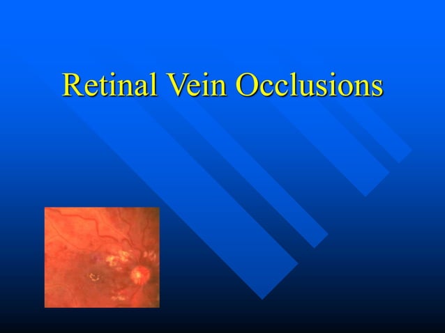 rvo.ppt retinal vein occlusion reti00nal | PPT