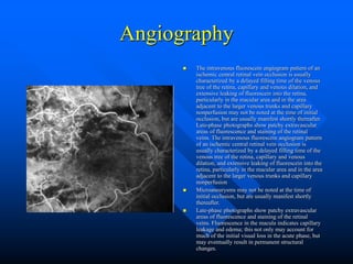 rvo.ppt retinal vein occlusion reti00nal | PPT