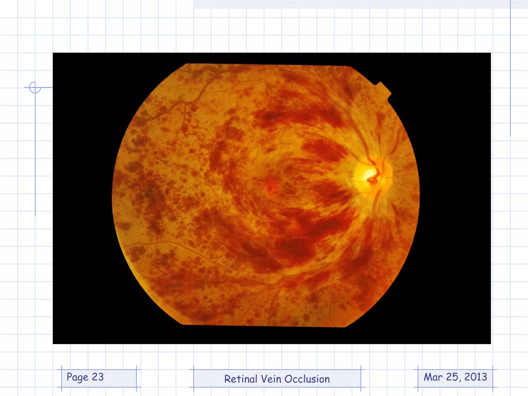 Central Retinal Vein Occlsion (CRVO) | PPT