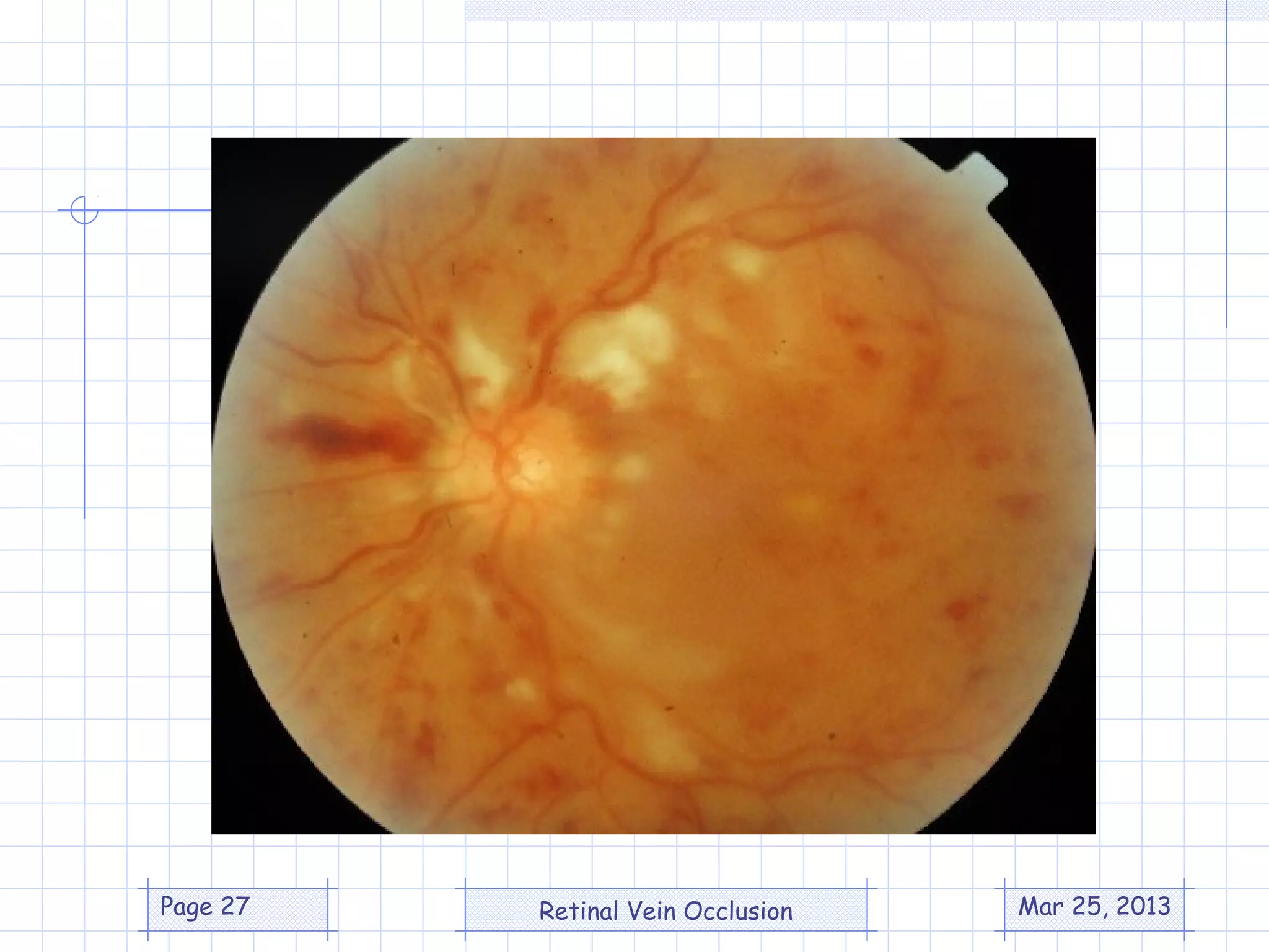 Central Retinal Vein Occlsion (CRVO) | PPT | Eye and Vision Conditions ...