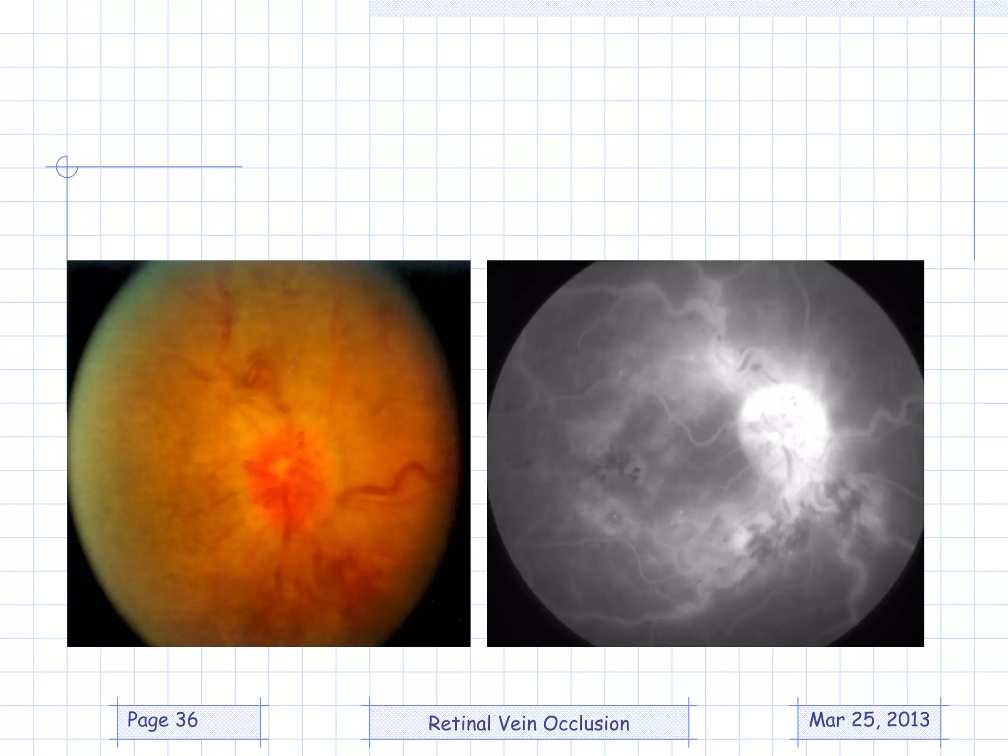 Central Retinal Vein Occlsion (CRVO) | PPT
