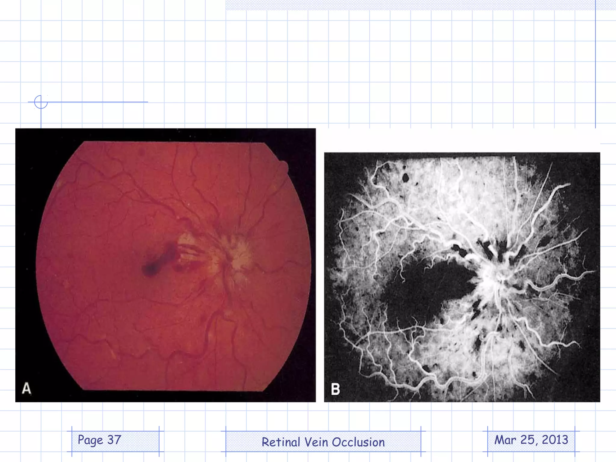 Central Retinal Vein Occlsion (CRVO) | PPT