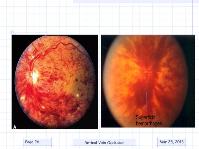 Central Retinal Vein Occlsion (CRVO) | PPT | Eye and Vision Conditions ...