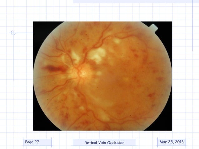 Central Retinal Vein Occlsion (CRVO) | PPT | Eye and Vision Conditions ...