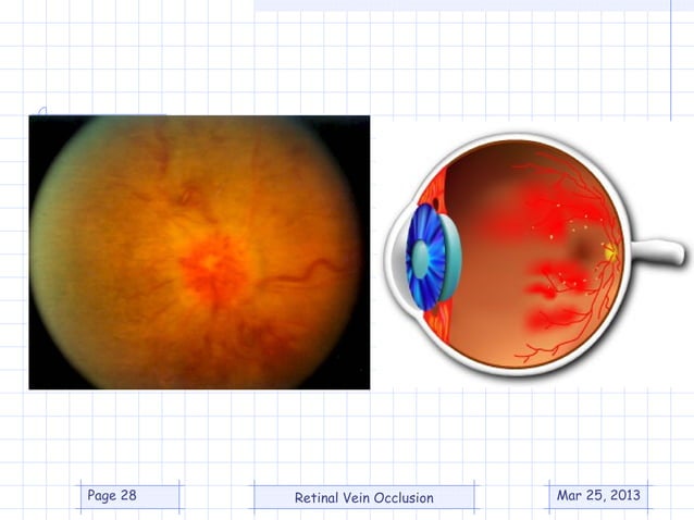 Central Retinal Vein Occlsion (CRVO) | PPT | Eye and Vision Conditions ...