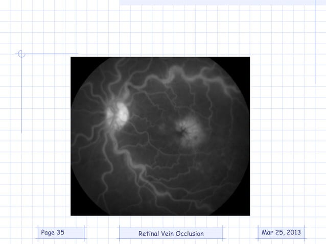Central Retinal Vein Occlsion (CRVO) | PPT | Eye and Vision Conditions ...