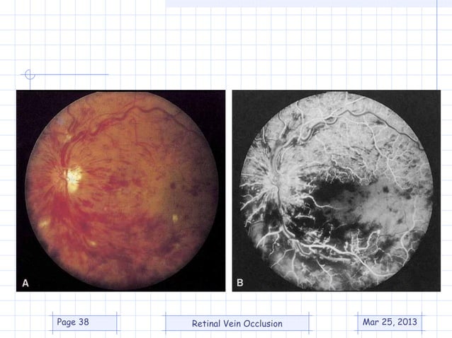 Central Retinal Vein Occlsion (CRVO) | PPT | Eye and Vision Conditions ...