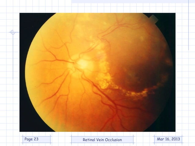 Branch Retinal Vein Occlsion (BRVO) | PPT | Eye and Vision Conditions ...