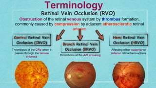 Rvo guidelines | PPT