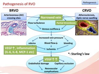 RVO risk factors and management pearls | PPTX