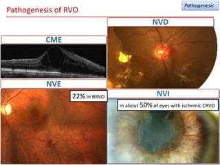 RVO risk factors and management pearls | PPTX