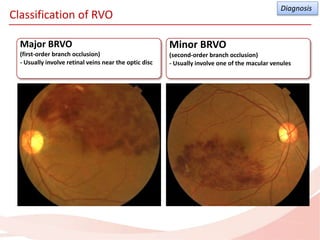 RVO risk factors and management pearls | PPT