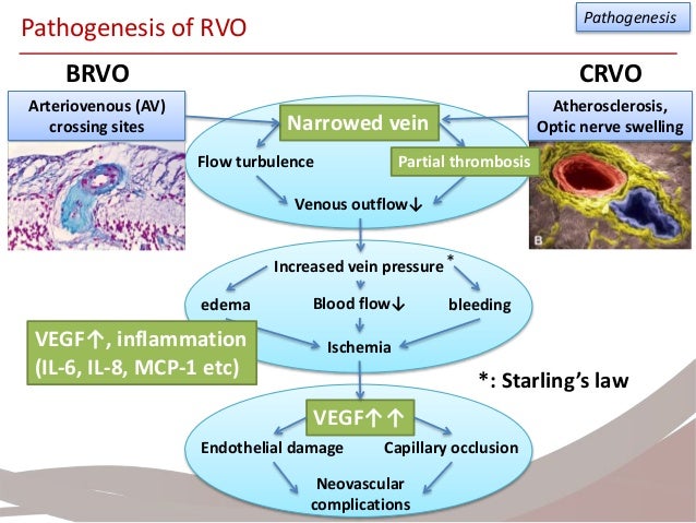 RVO risk factors and management pearls