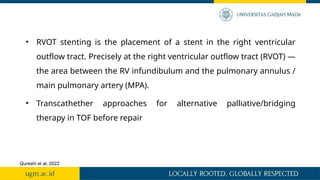 RVOT Stenting in Tetralogy of Fallot.... | PPTX