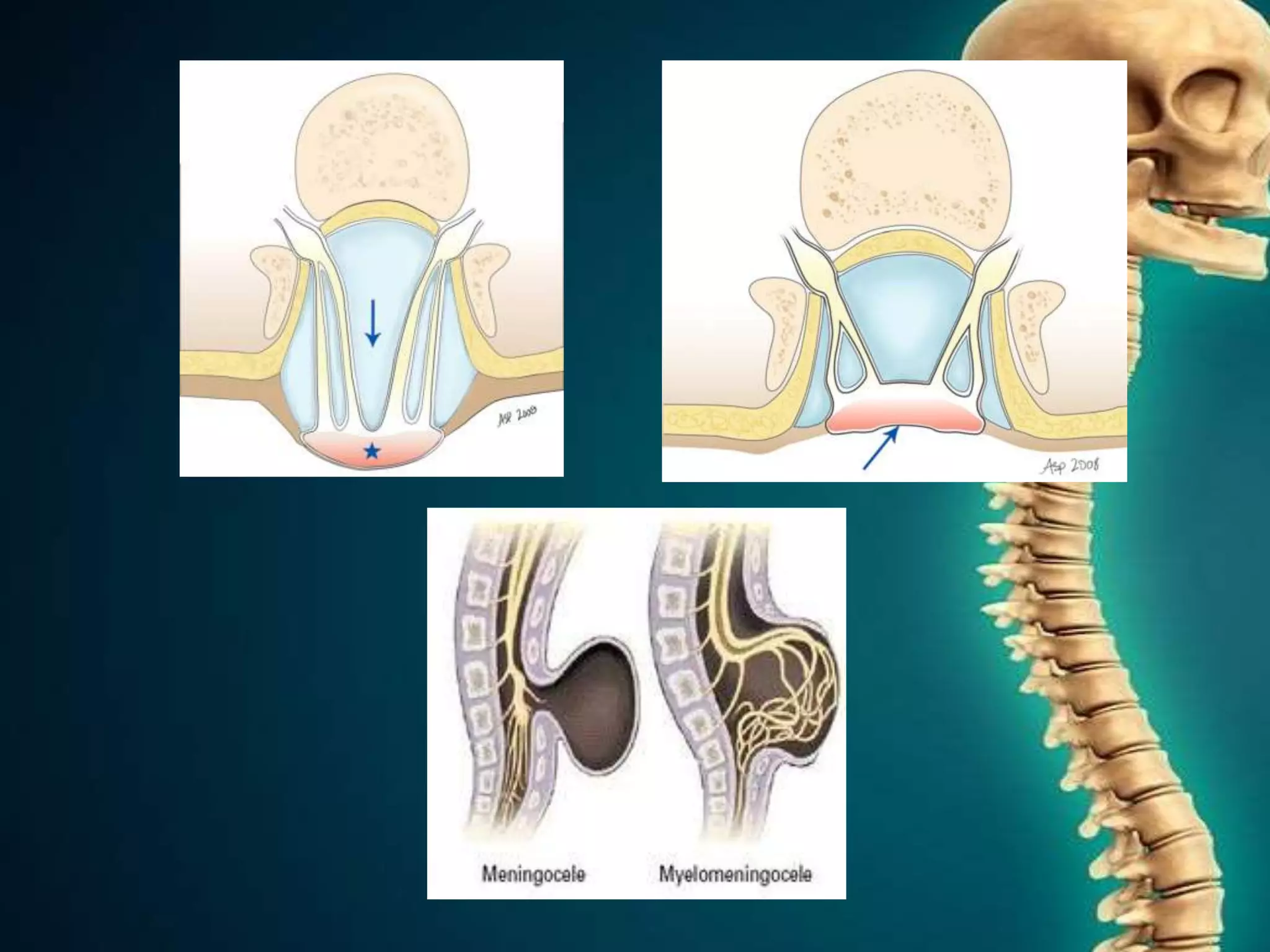 Congenital Anomalies Of Spine And Spinal Cord | PPTX | Brain and ...