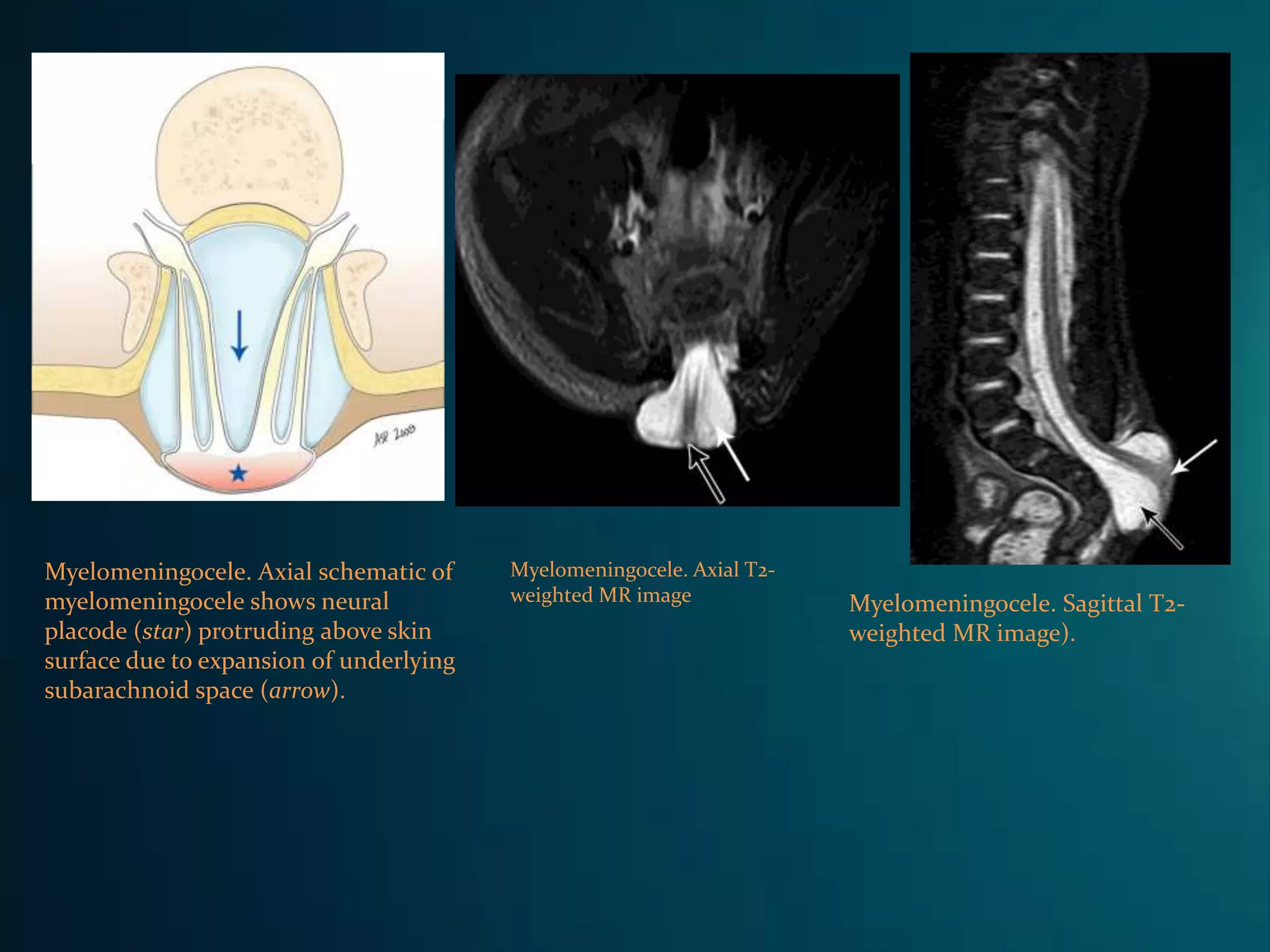 Congenital Anomalies Of Spine And Spinal Cord | PPTX | Brain and Nervous System Disorders ...