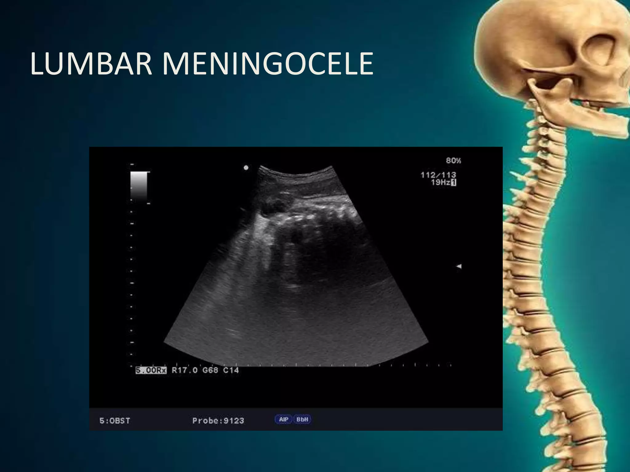 Congenital Anomalies Of Spine And Spinal Cord | PPTX | Brain and Nervous System Disorders ...