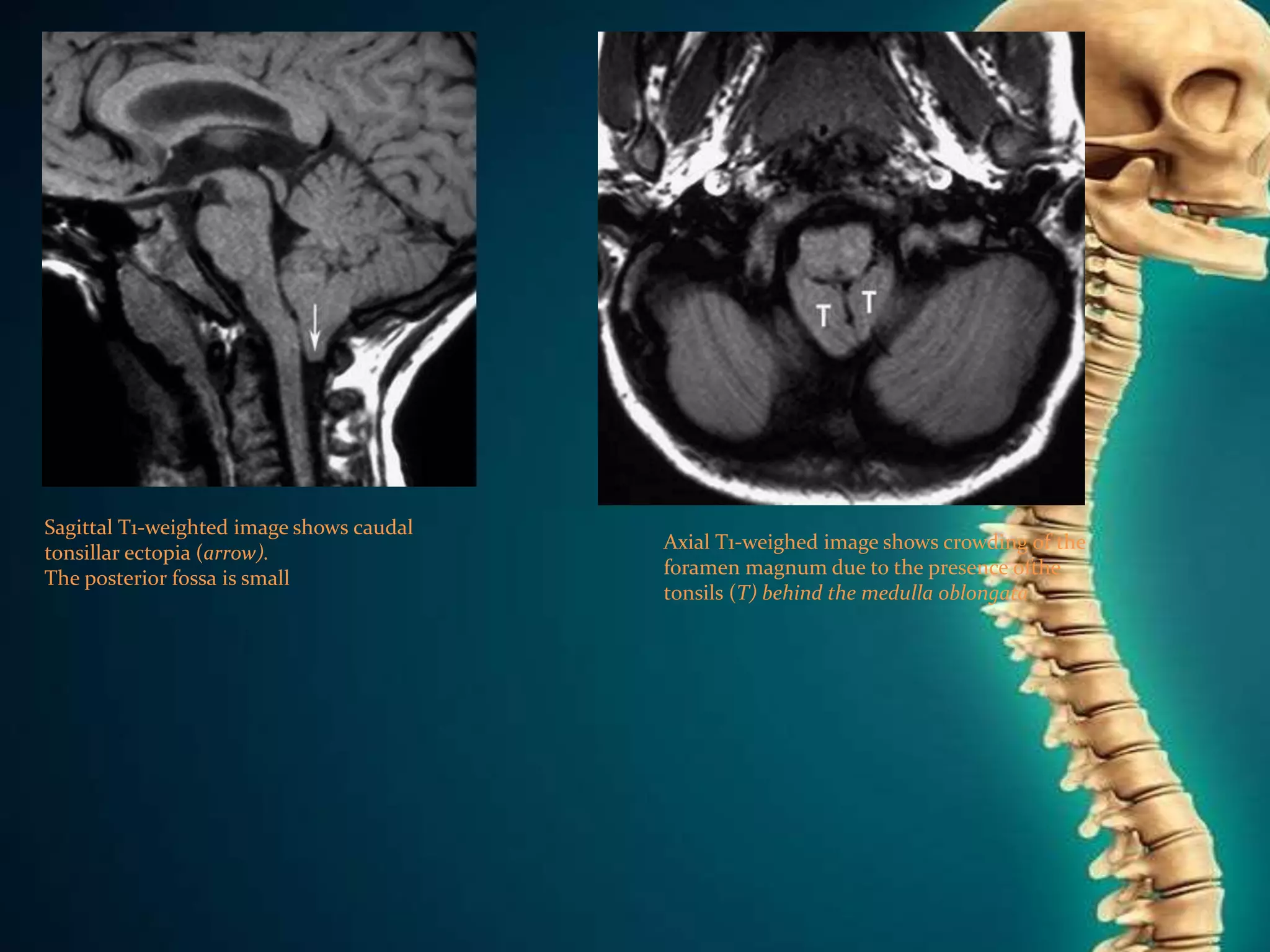 Congenital Anomalies Of Spine And Spinal Cord | PPTX | Brain and Nervous System Disorders ...