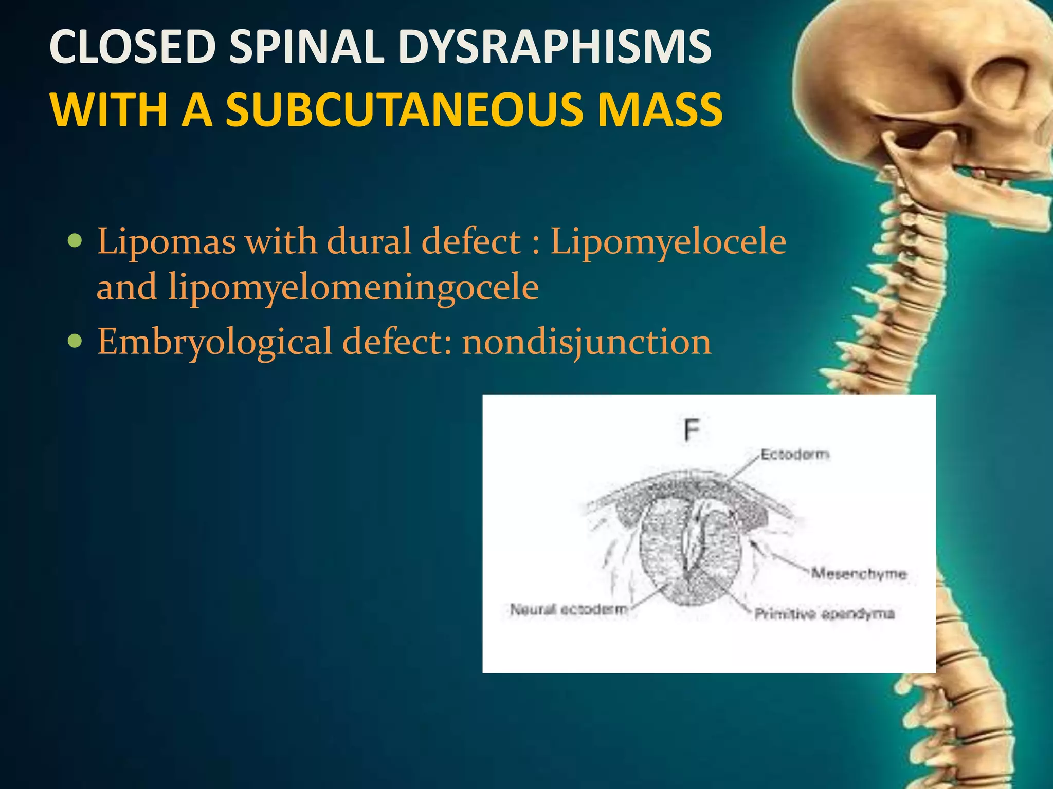 Congenital Anomalies Of Spine And Spinal Cord | PPTX | Brain and Nervous System Disorders ...