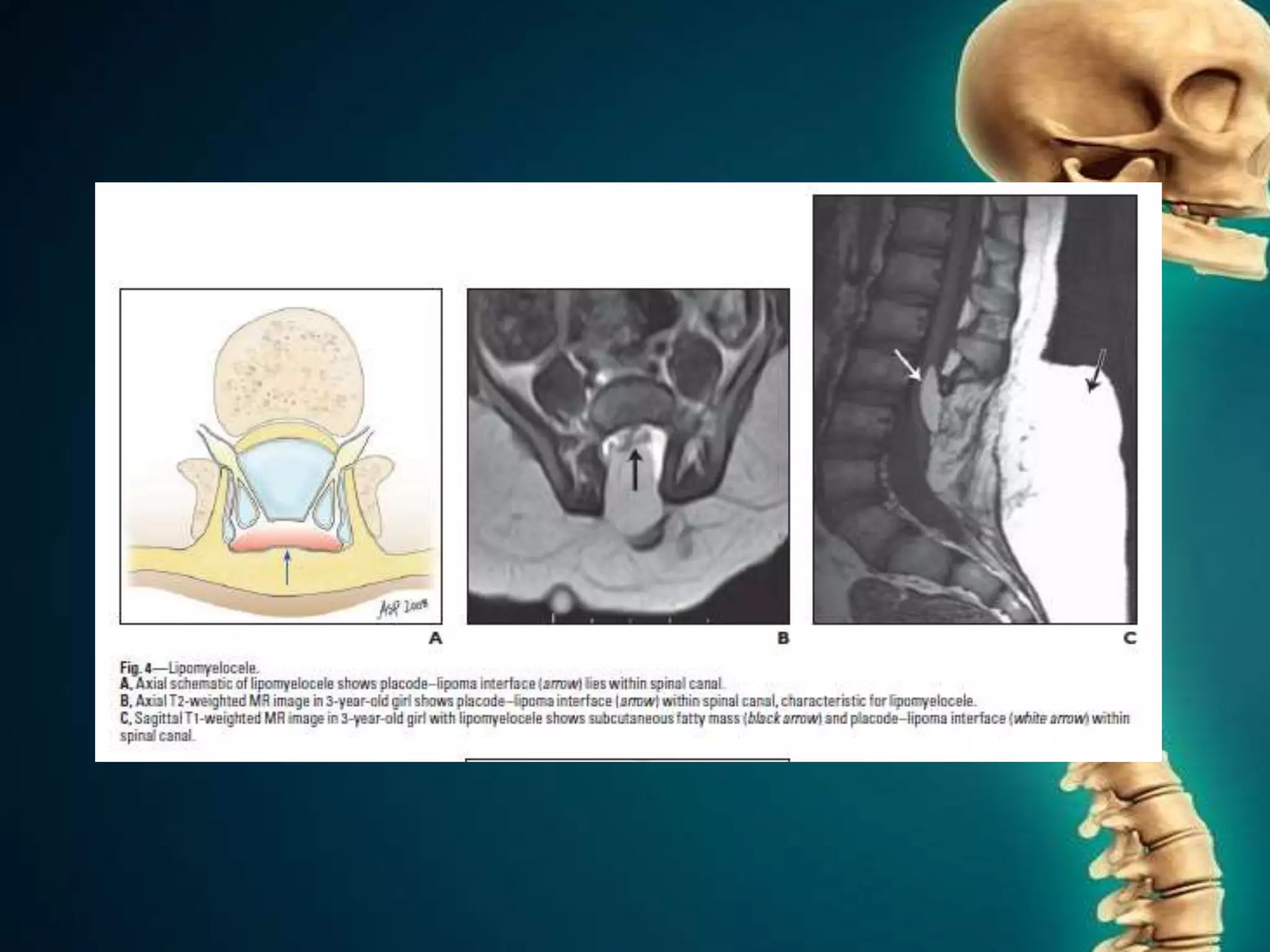 Congenital Anomalies Of Spine And Spinal Cord | PPTX | Brain and Nervous System Disorders ...