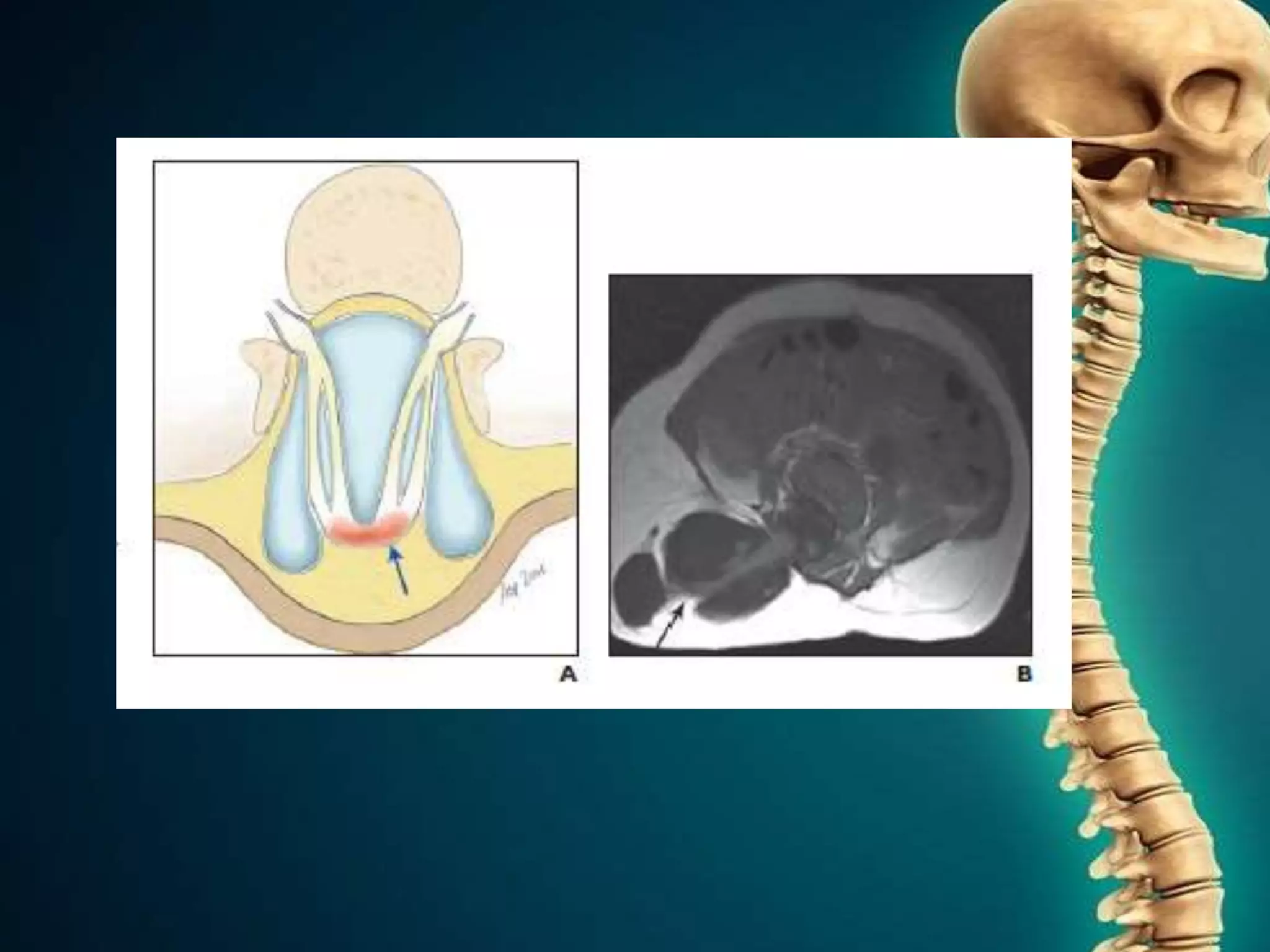 Congenital Anomalies Of Spine And Spinal Cord | PPTX | Brain and Nervous System Disorders ...