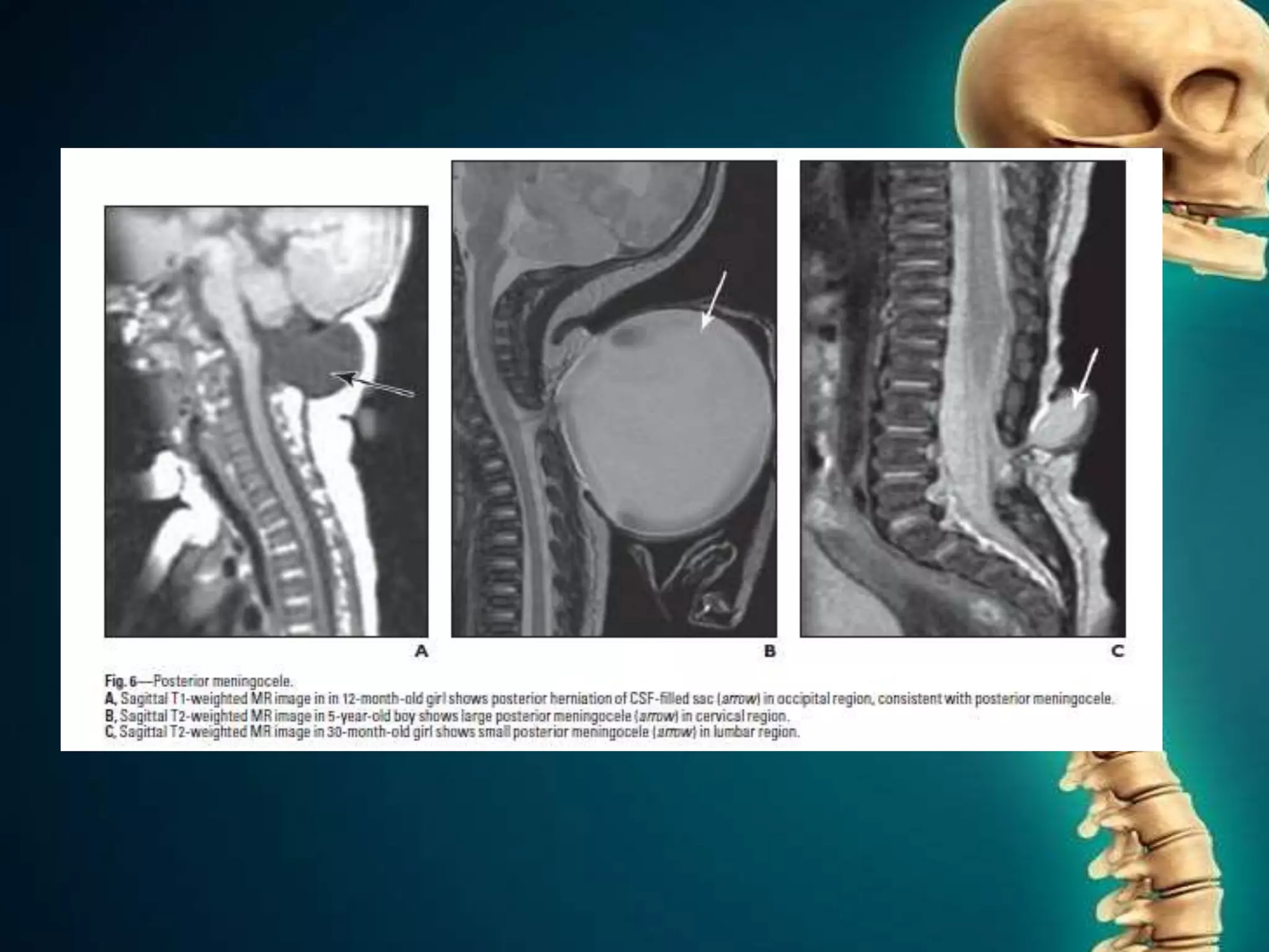 Congenital Anomalies Of Spine And Spinal Cord | PPTX | Brain and Nervous System Disorders ...