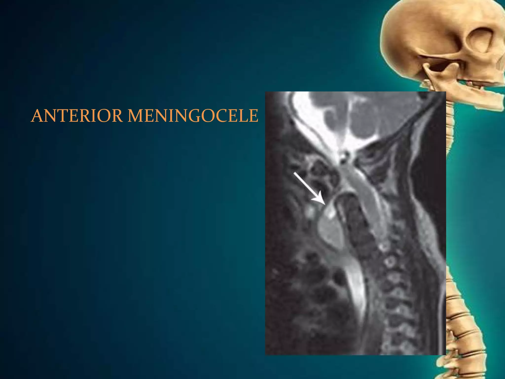 Congenital Anomalies Of Spine And Spinal Cord | PPTX | Brain and Nervous System Disorders ...