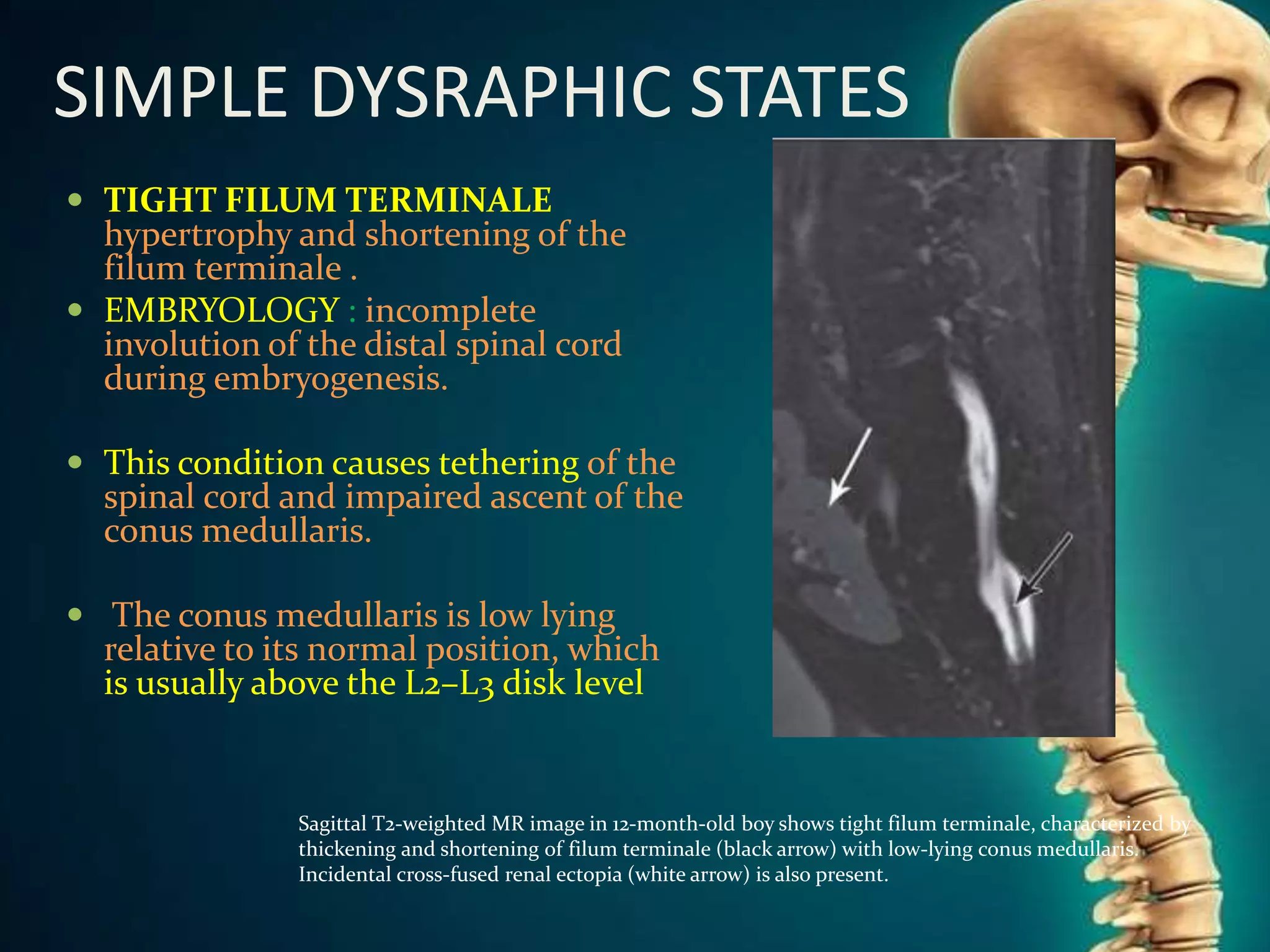 Congenital Anomalies Of Spine And Spinal Cord | PPTX | Brain and Nervous System Disorders ...