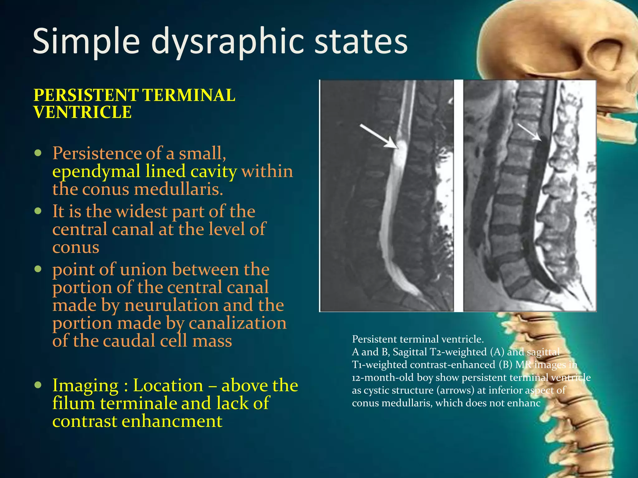 Congenital Anomalies Of Spine And Spinal Cord | PPTX | Brain and Nervous System Disorders ...