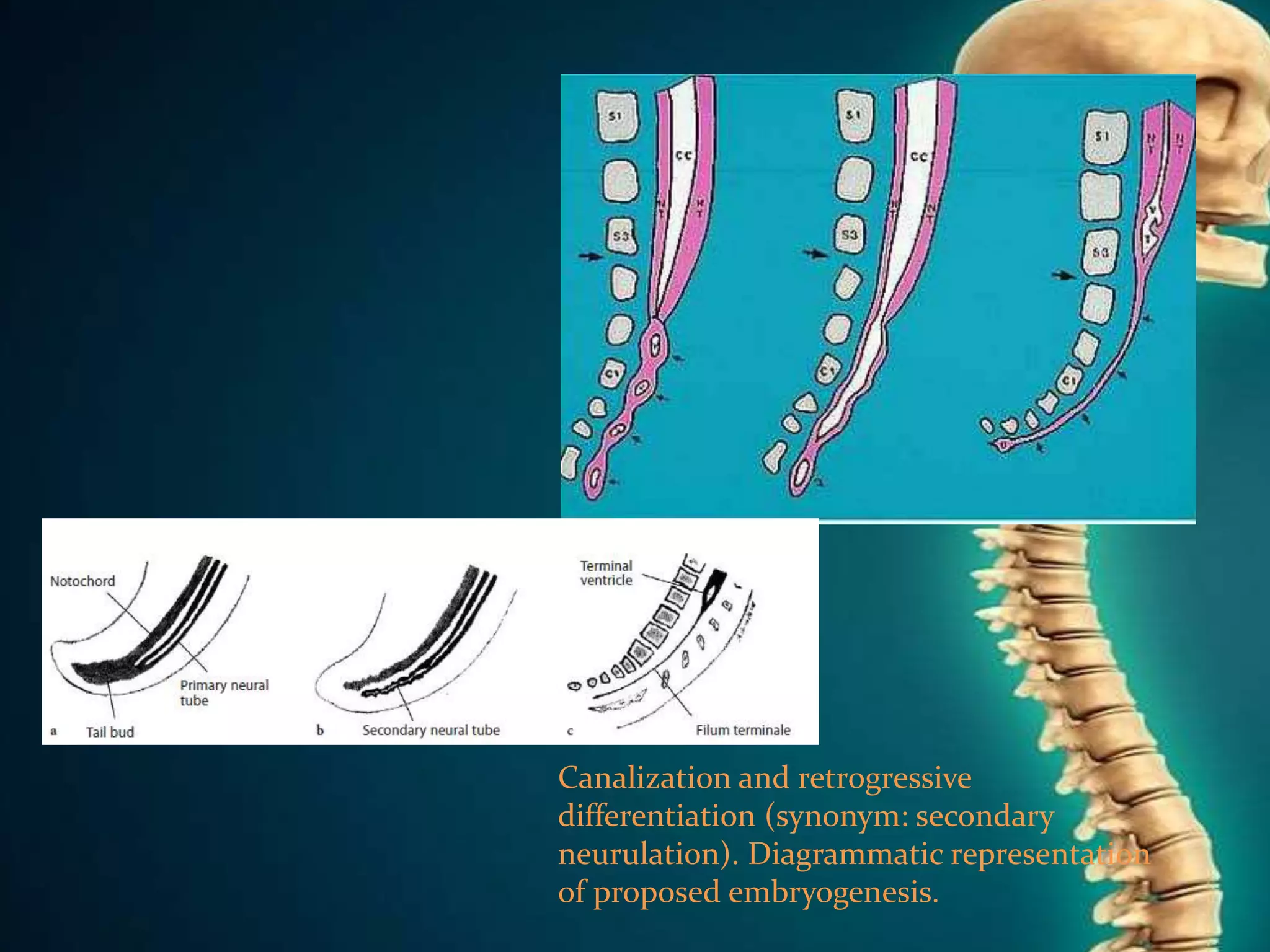 Congenital Anomalies Of Spine And Spinal Cord | PPTX