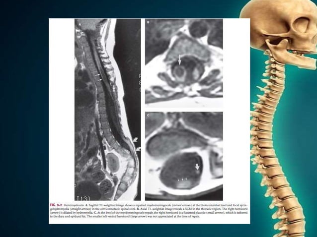 Congenital Anomalies Of Spine And Spinal Cord | PPTX | Brain and Nervous System Disorders ...
